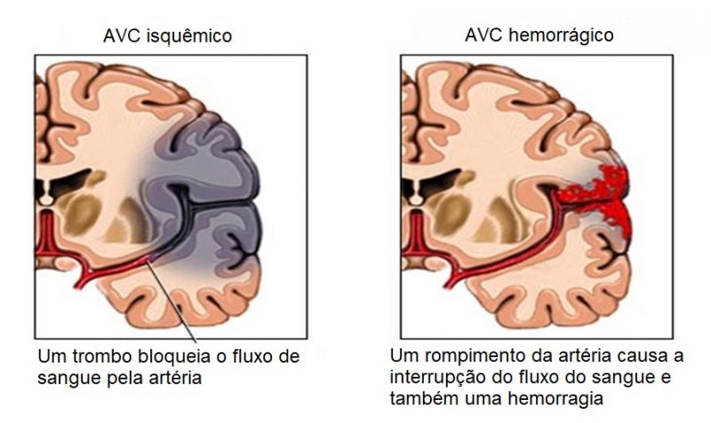 Avc Ou Derrame Tudo O Que Você Deve Saber Tópicos De Saúde